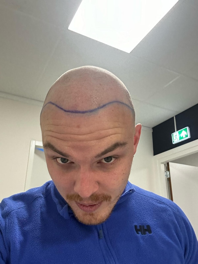 Mathijs (25) en Thomas (24) kozen voor een haartransplantatie: ‘De ...