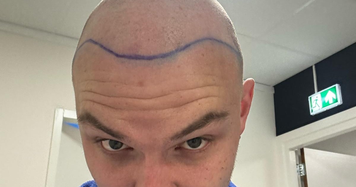 Mathijs (25) en Thomas (24) kozen voor een haartransplantatie: ‘De ...