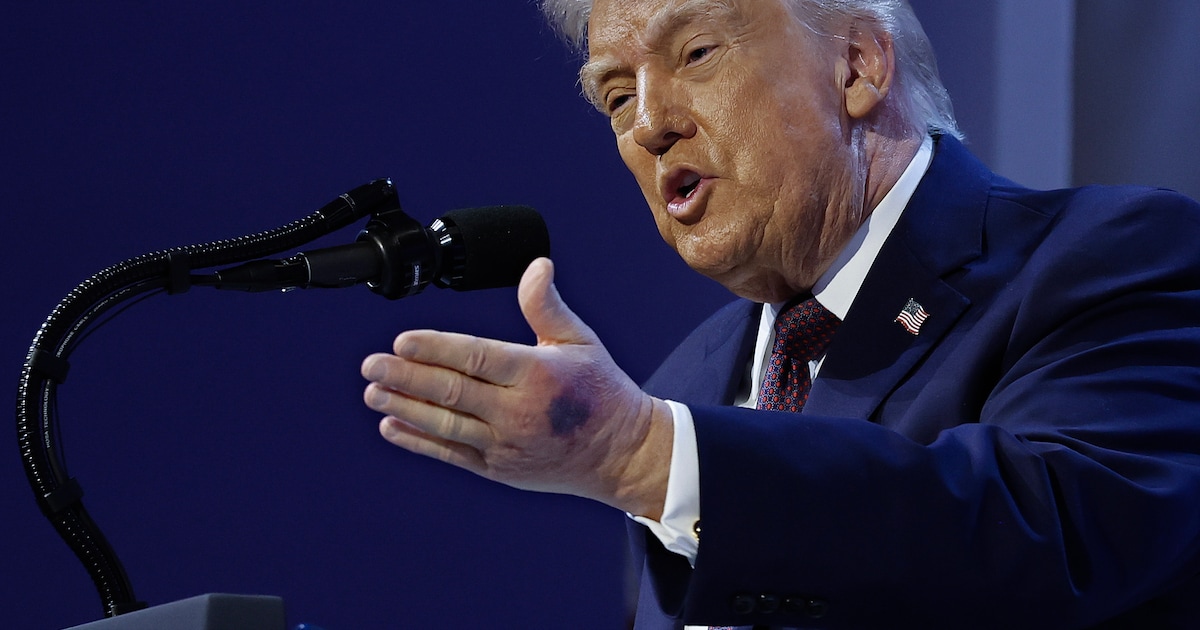 Trump bagatelliseert blauwe plekken: alleen maar ‘hand gestoten aan ...