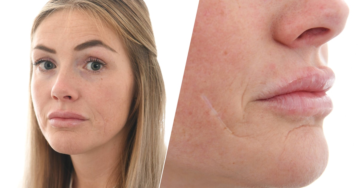 Linde werd verminkt door schoonheidsbehandeling stagiaire: salon moet ...