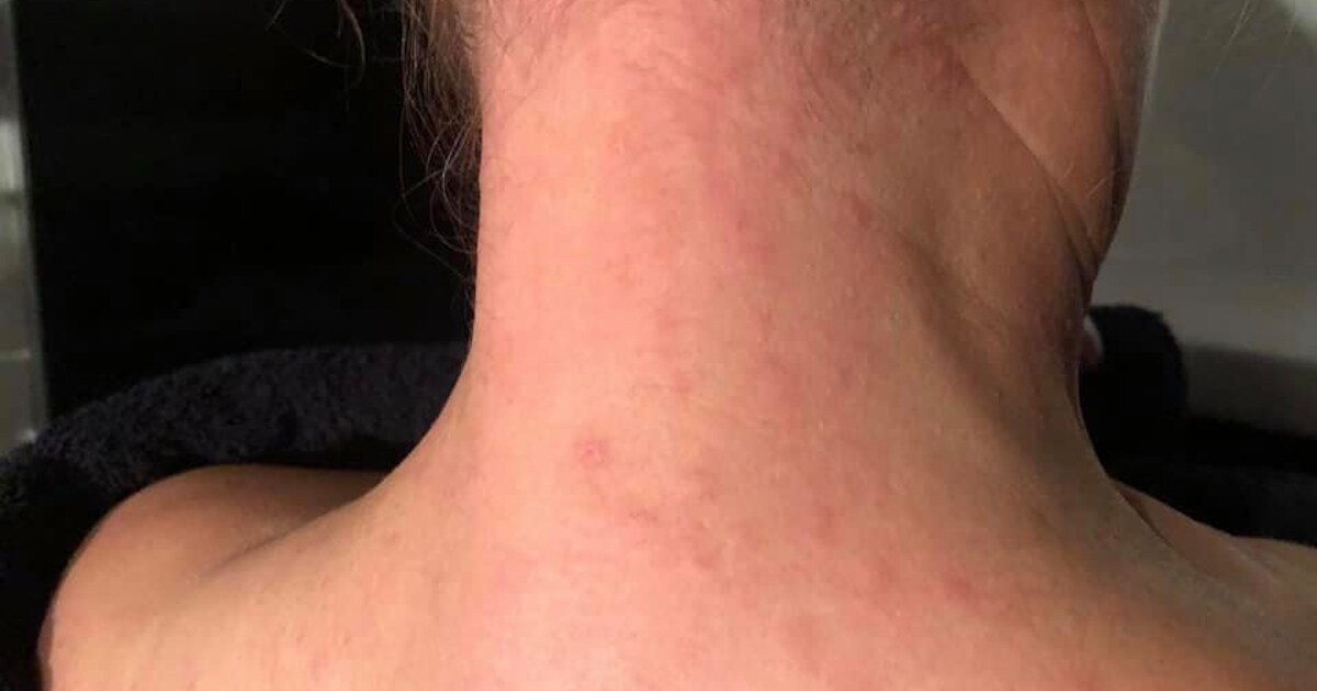 Tips van ervaringsdeskundigen: dit doen mensen tegen de jeuk van de ...