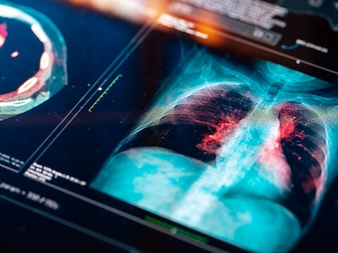 Hoe herken je een hersenaneurysma: dit zijn de symptomen | Gezond | BD.nl