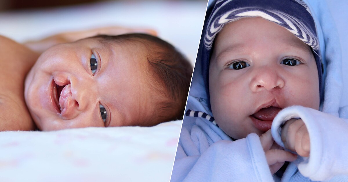 300 baby’s per jaar worden geboren met schisis: ‘Sommige patiënten blijven een afwijkende spraak ...